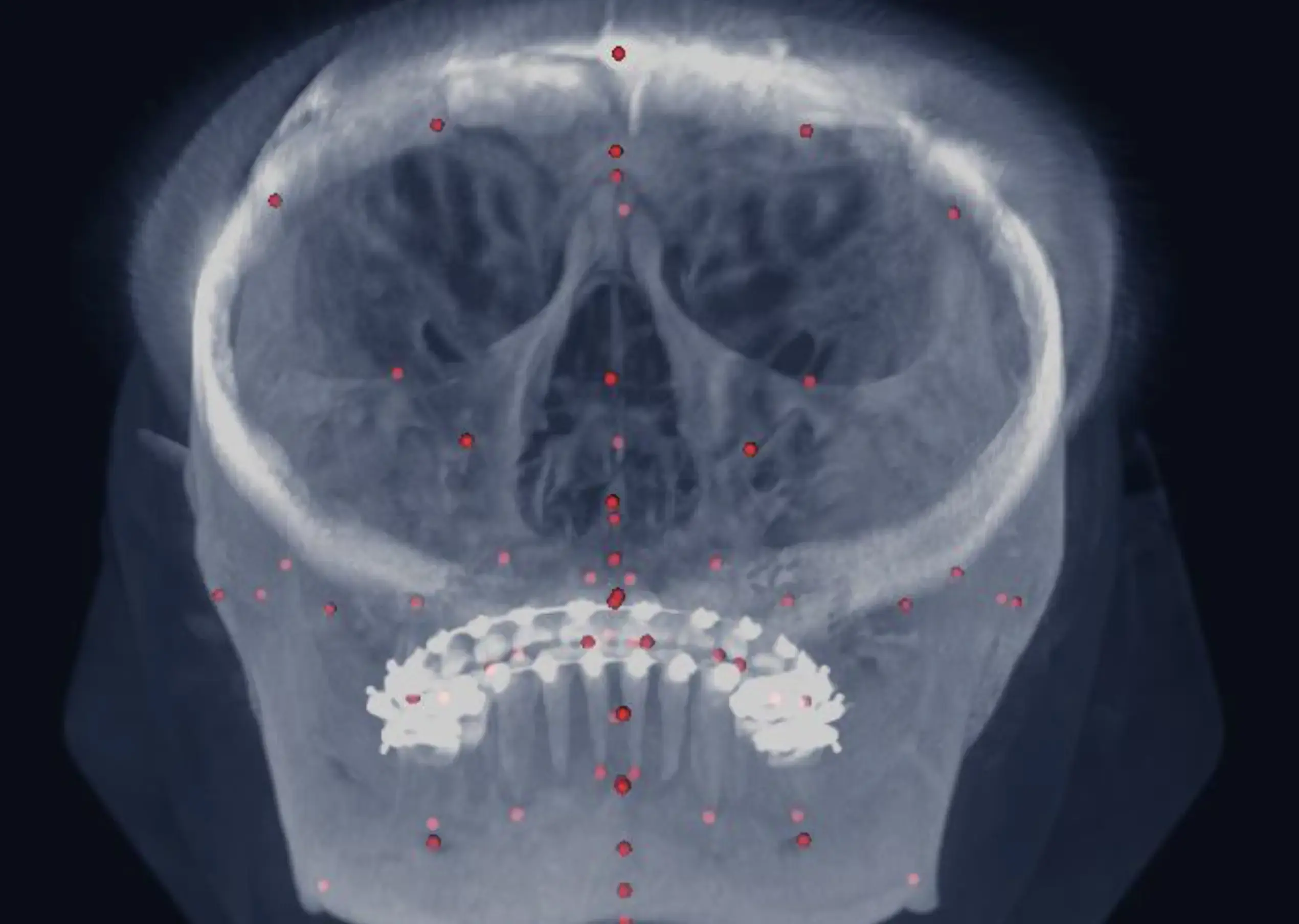 Frontal CT image of a skull with braces on the teeth and red dots on ...